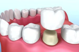 Loose Dental Crown: Common Signs and Re-cementing Options