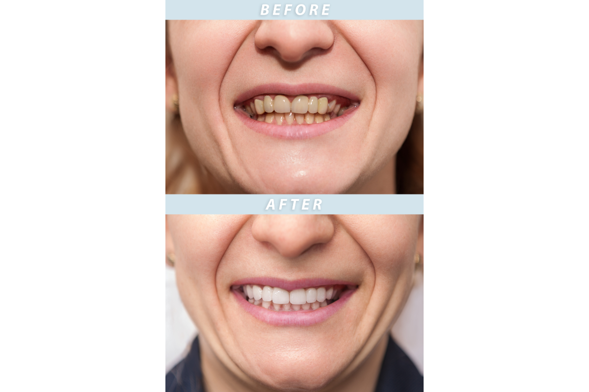 Can You Get Veneers For Crooked Teeth?