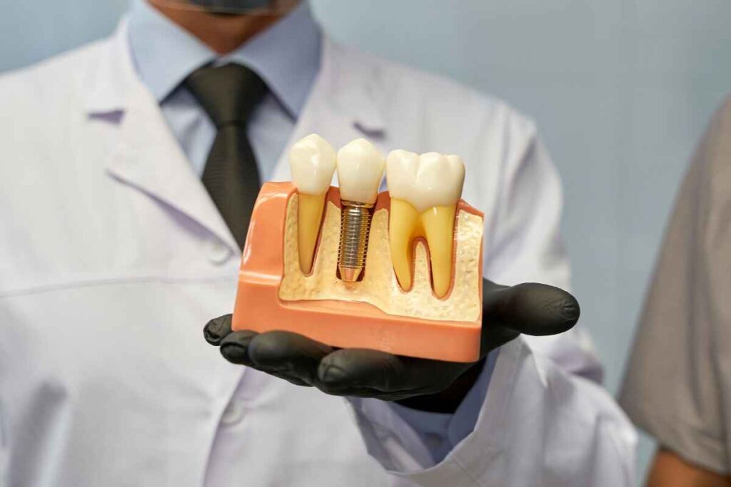 Dental Implants for Molar Teeth – Everything You Need to Know