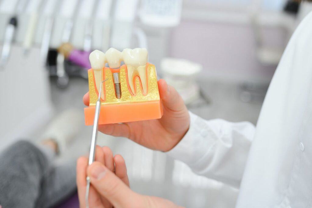 Dental Implants for Molar Teeth – Everything You Need to Know